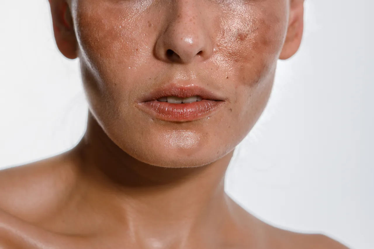 Taches brunes et hyperpigmentation : La routine qui redonne de l’éclat